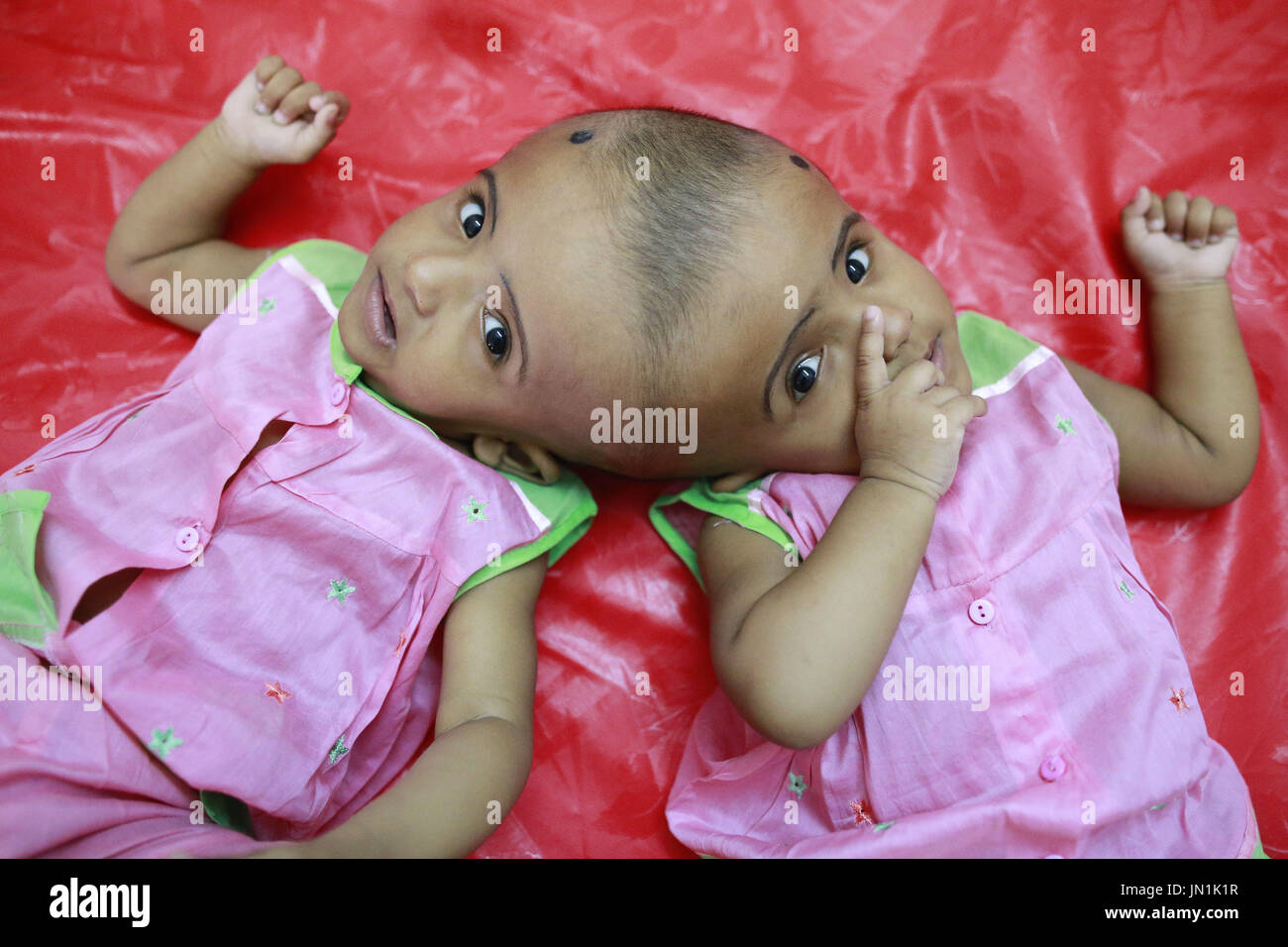 Conjoined twins identical twins born hi-res stock photography and ...