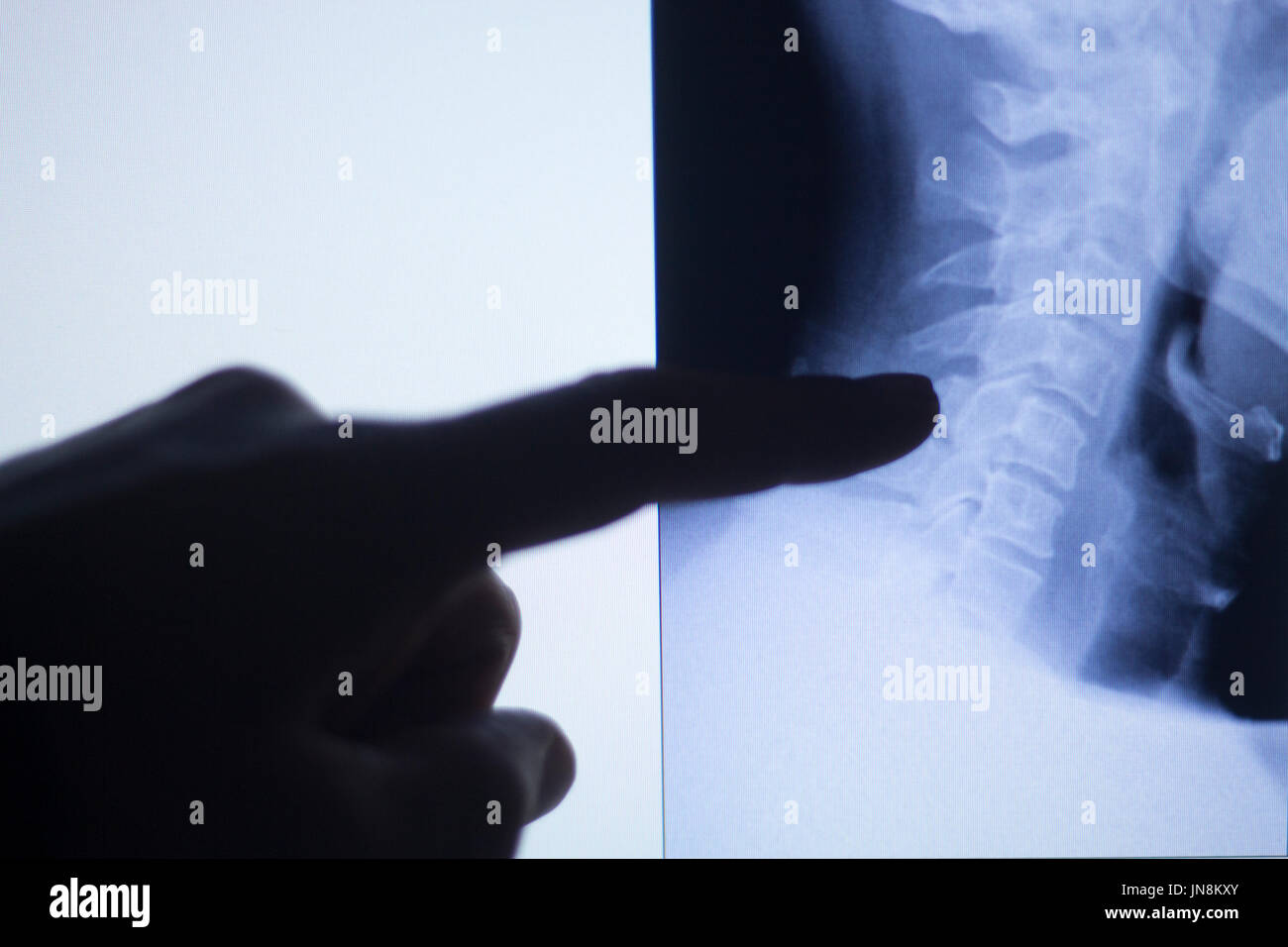Back spine vertabrae and neck xray test scan results of patient with ...