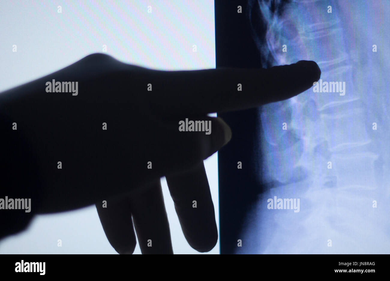 Back spine vertabrae xray test scan results of patient with arthritis ...