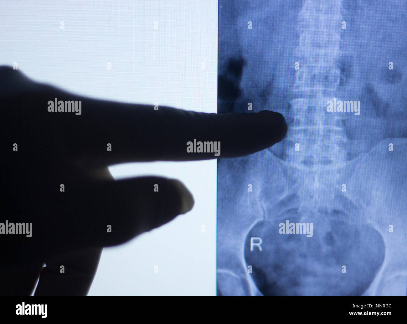 Back spine vertabrae xray test scan results of patient with arthritis ...