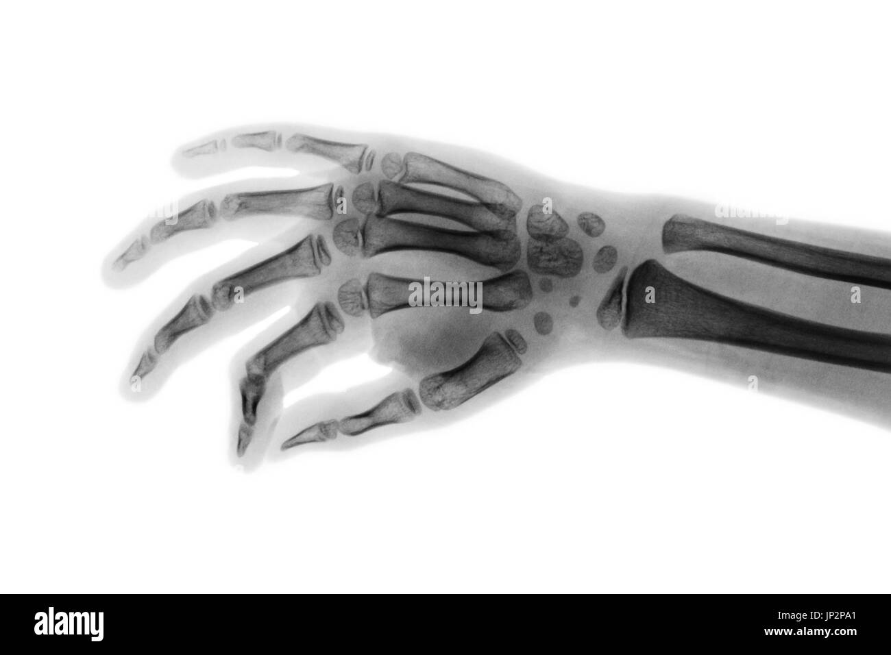 Xray Hand Child High Resolution Stock Photography and Images - Alamy