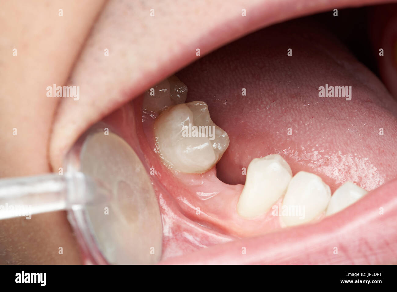Open mouth human teeth hi-res stock photography and images - Alamy