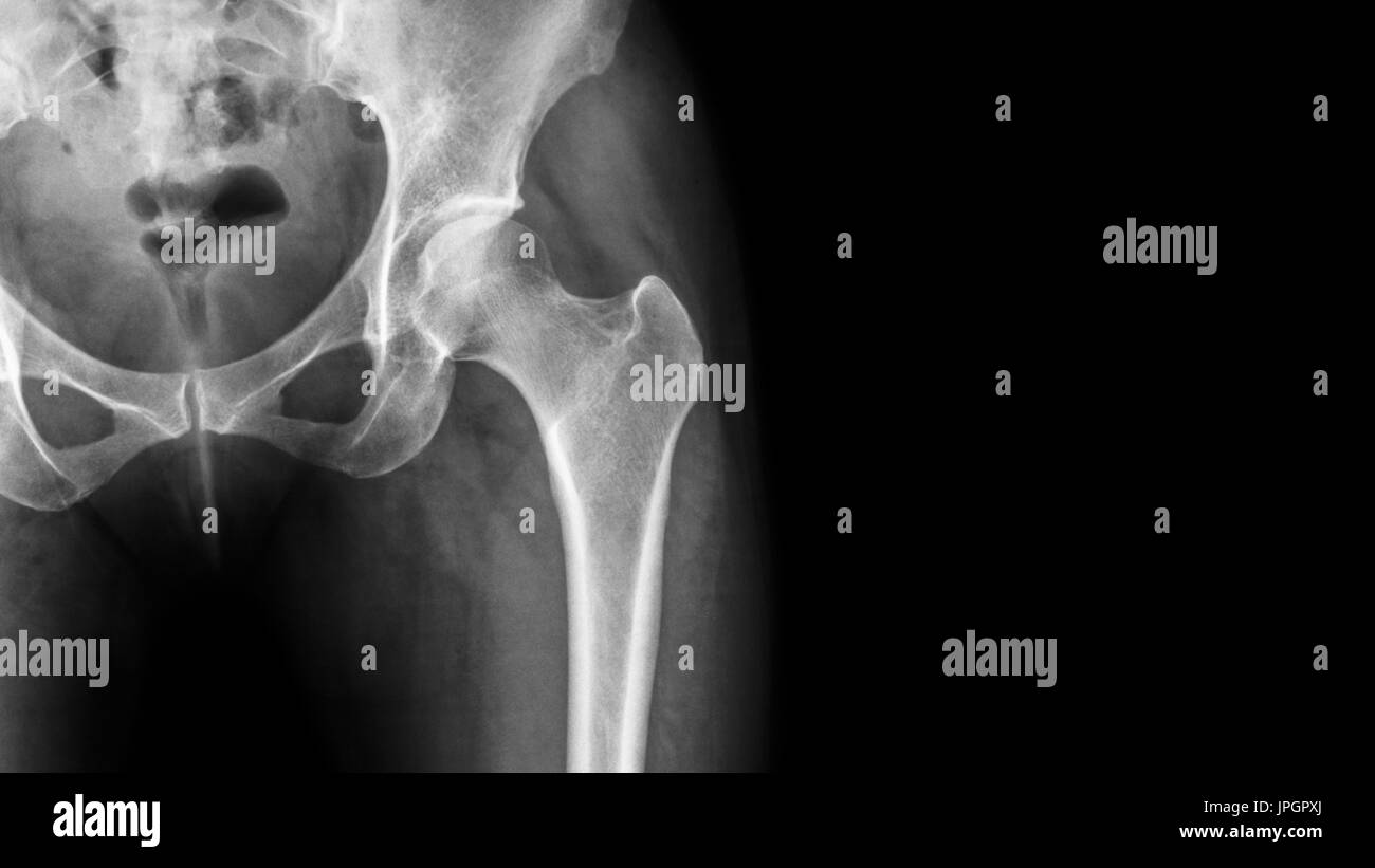Normal Pelvis X Ray Film X Ray Normal Pelvis" By Puwadol