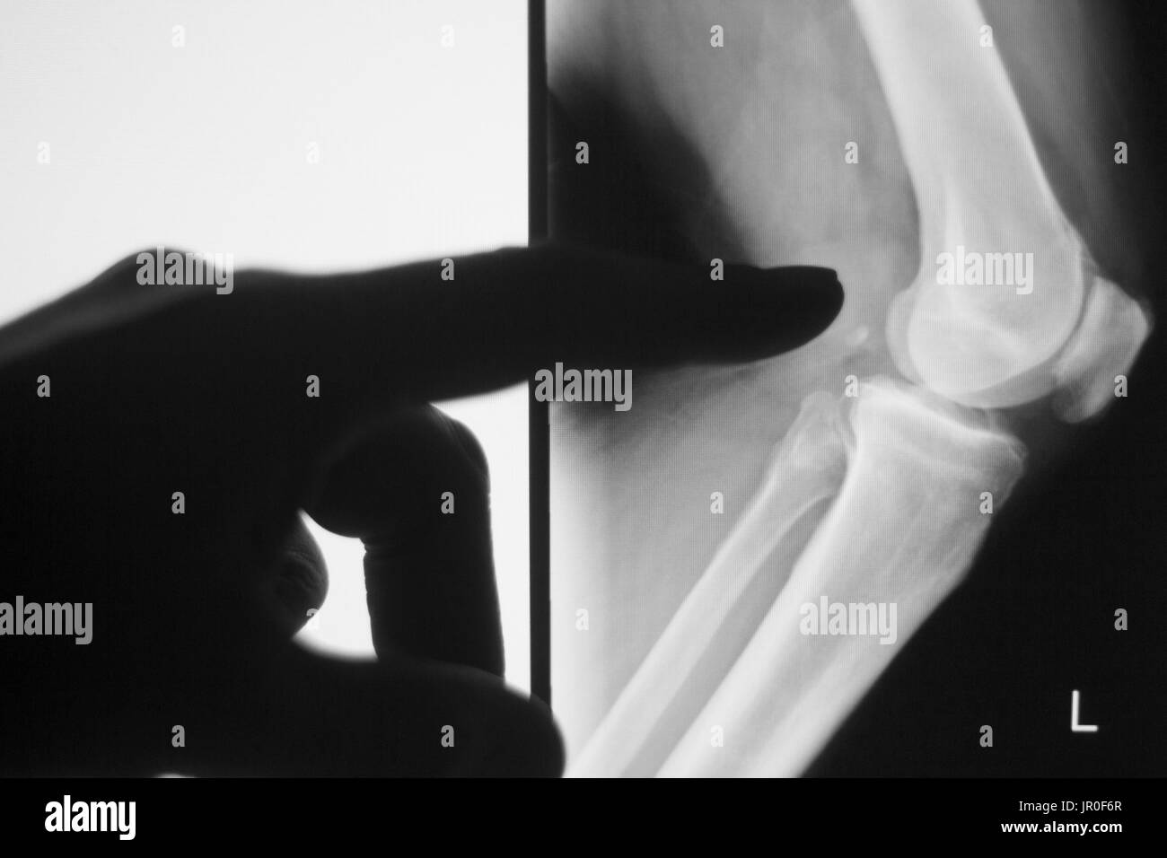 Bone scan knees Black and White Stock Photos & Images - Alamy