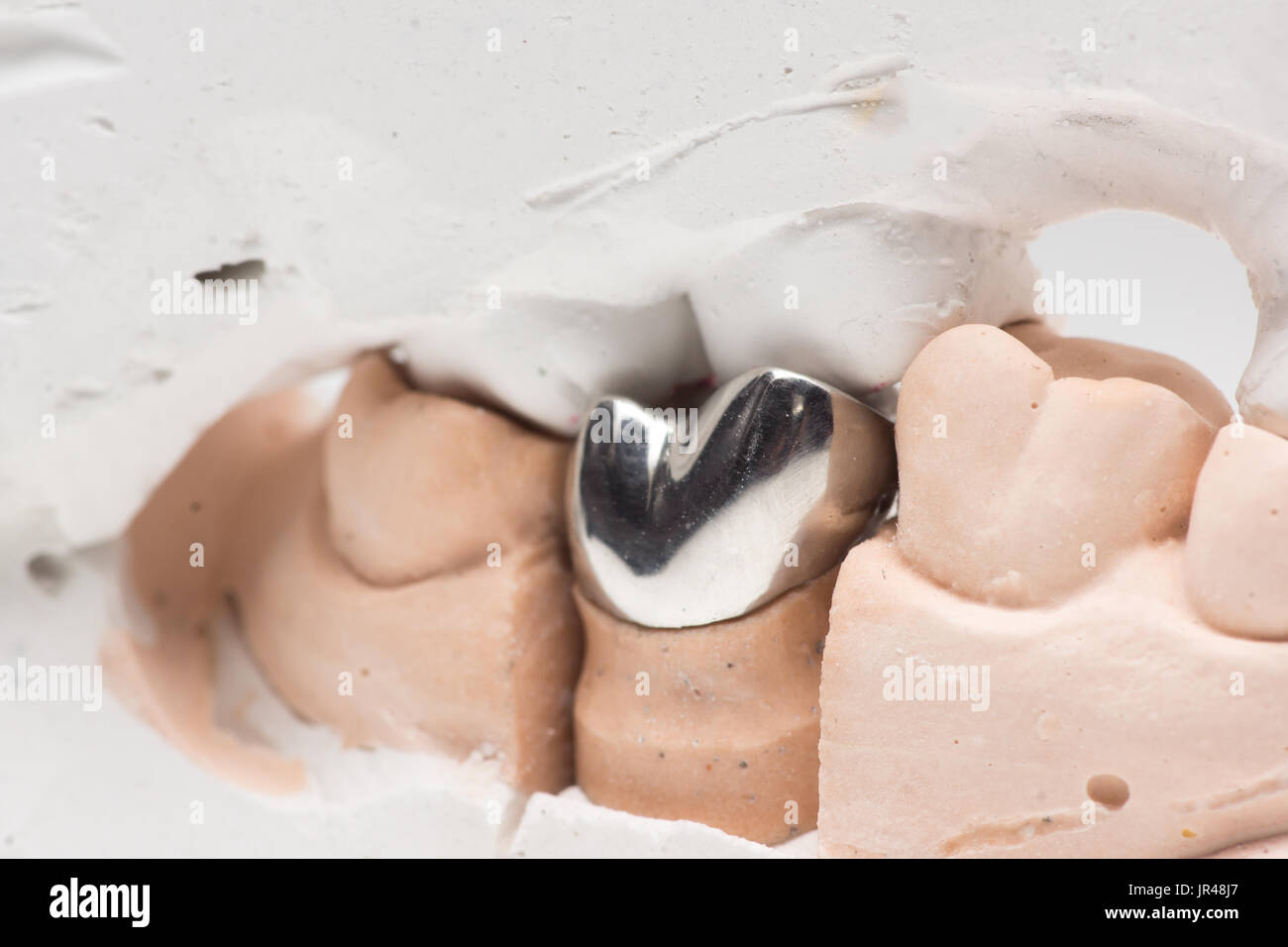 Steel artificial dental crown for dentition restoration Stock Photo - Alamy