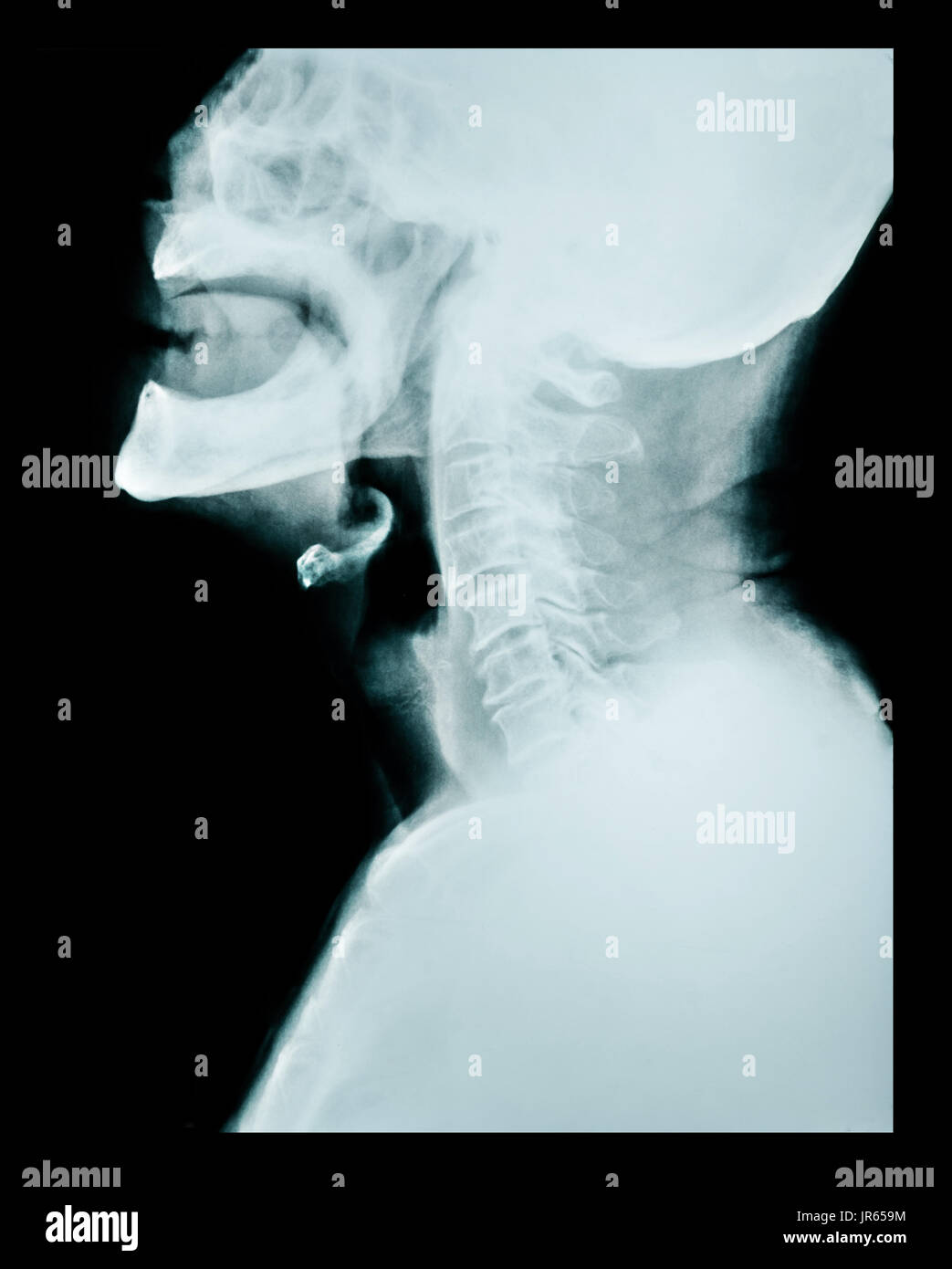 Xray of neck surgery hi-res stock photography and images - Alamy