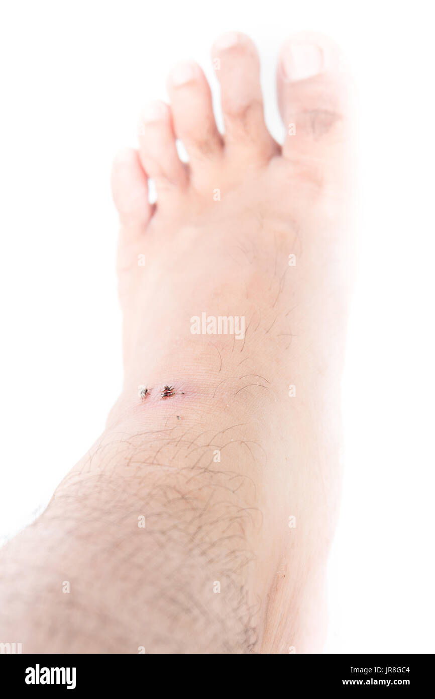 wound on skin Stock Photo - Alamy