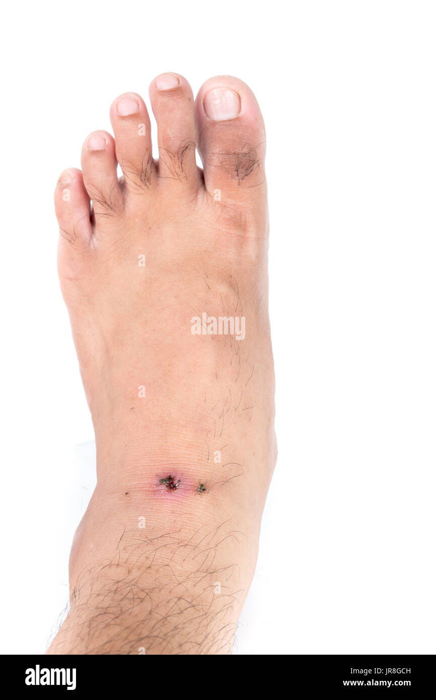 Ecchymosis hi-res stock photography and images - Alamy