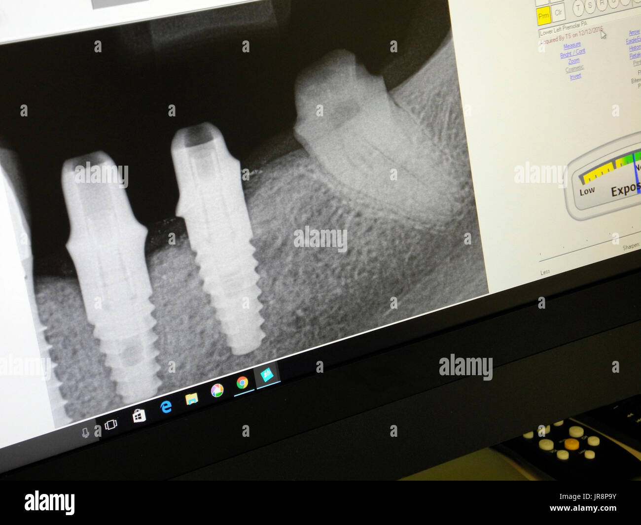 Teeth xray hi-res stock photography and images - Alamy