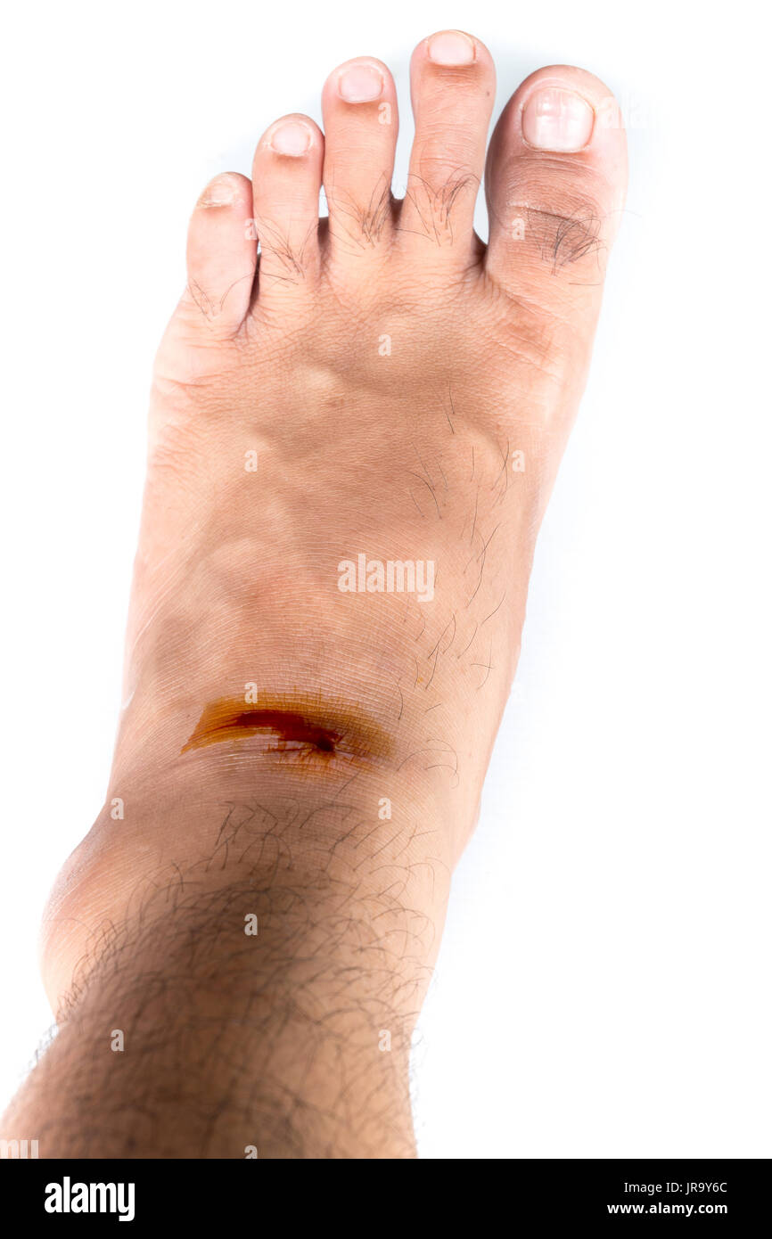 wound on skin Stock Photo - Alamy