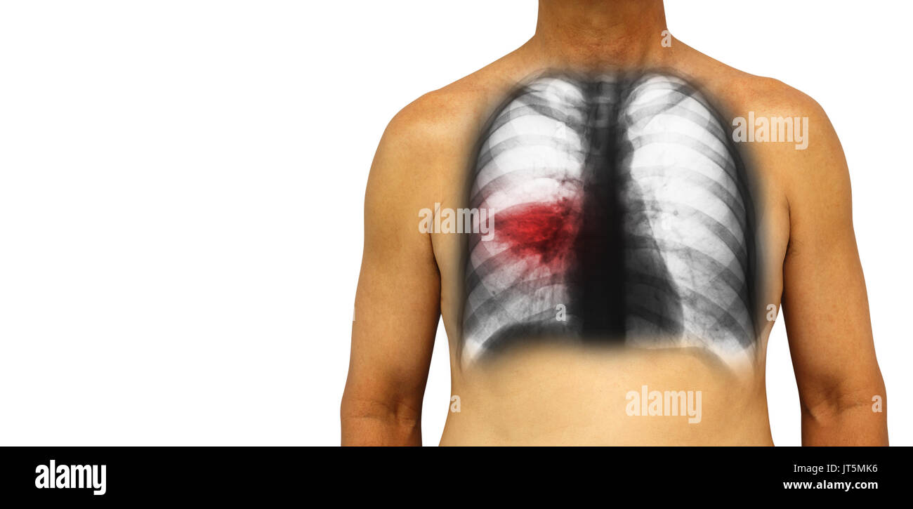 Pulmonary tuberculosis . Human chest with x-ray show patchy infiltrate ...