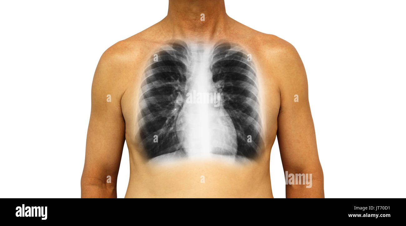 Human chest with x-ray of normal lung . Isolated background Stock Photo ...