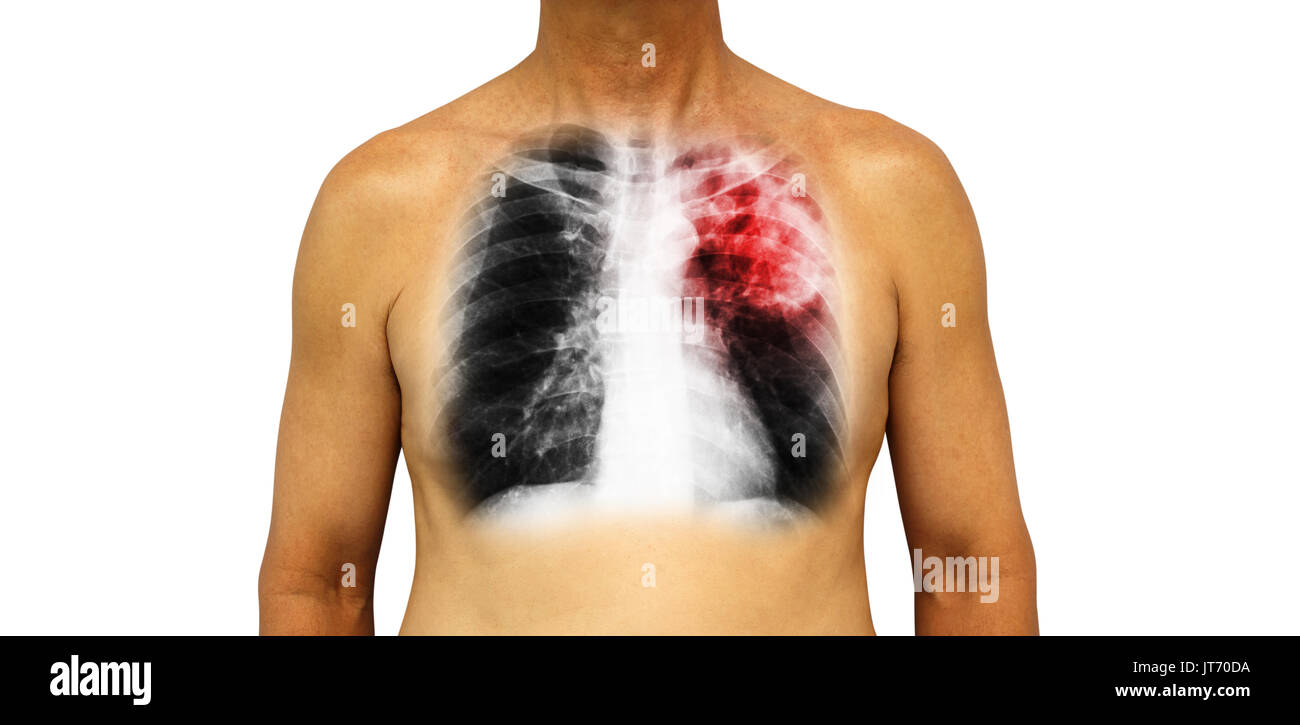 Pulmonary tuberculosis . Human chest with x-ray show patchy infiltrate ...
