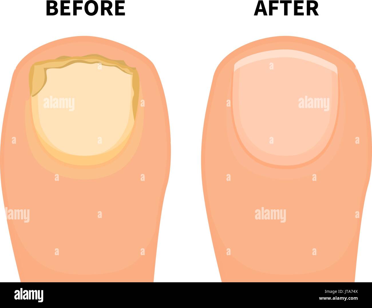 Vector toe nail before and after fungal disease Stock Vector Image ...