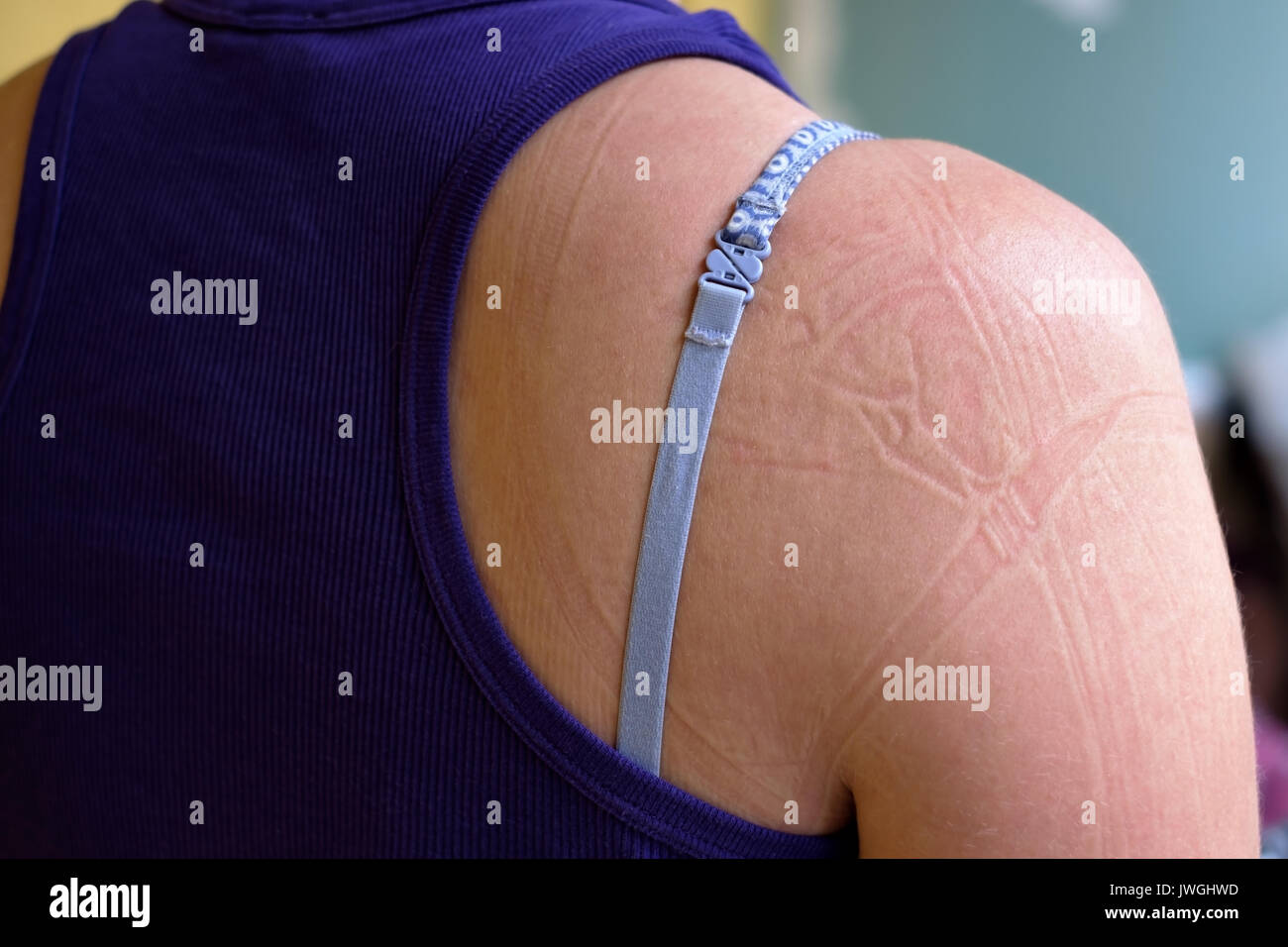 A trace from clothes on a female shoulder Stock Photo - Alamy