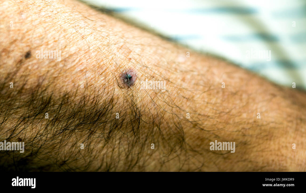 Elderly wound care hi-res stock photography and images - Alamy