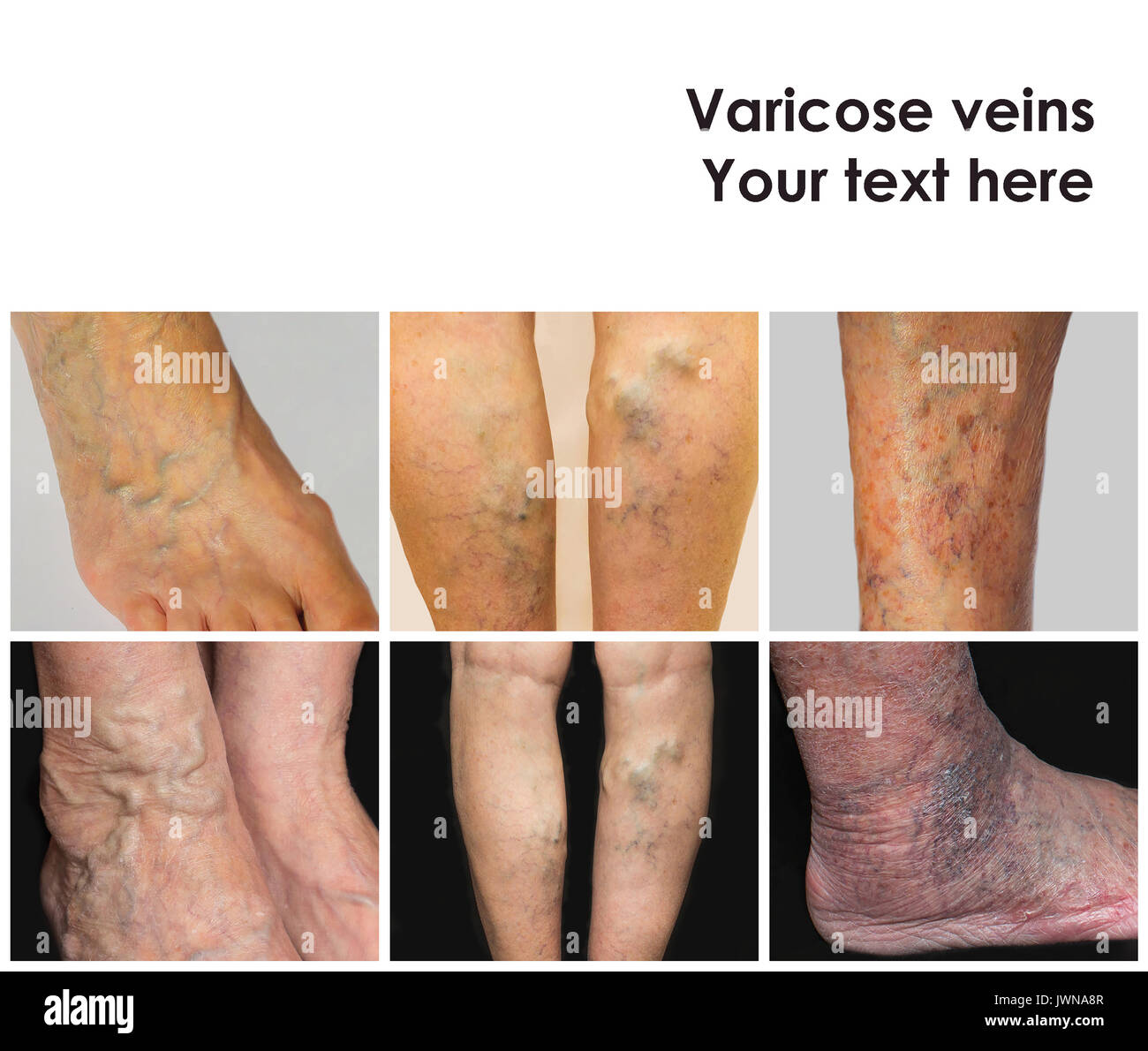 Collage from images of varicose veins Stock Photo - Alamy