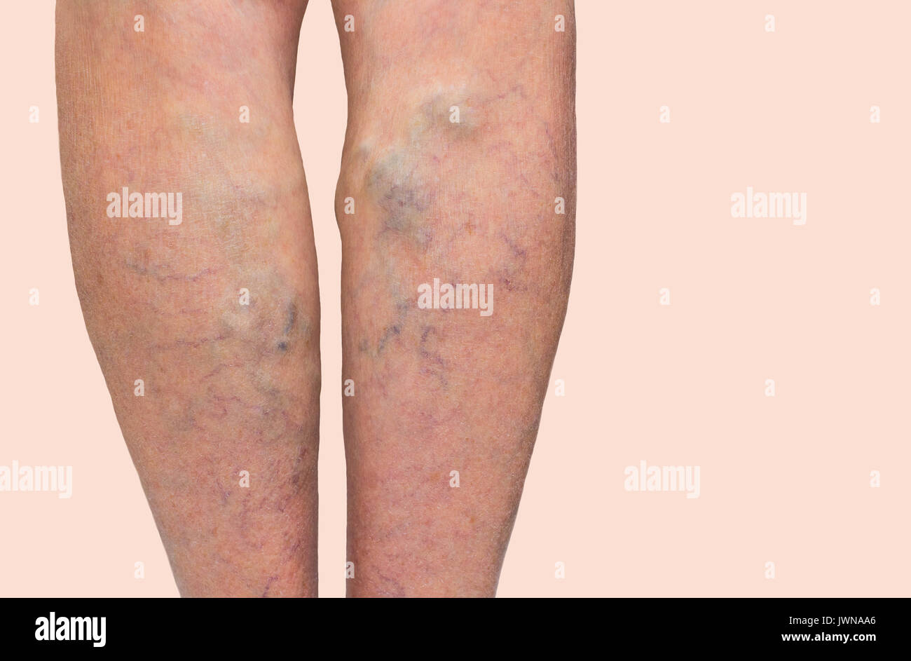 Oedema legs hi-res stock photography and images - Alamy