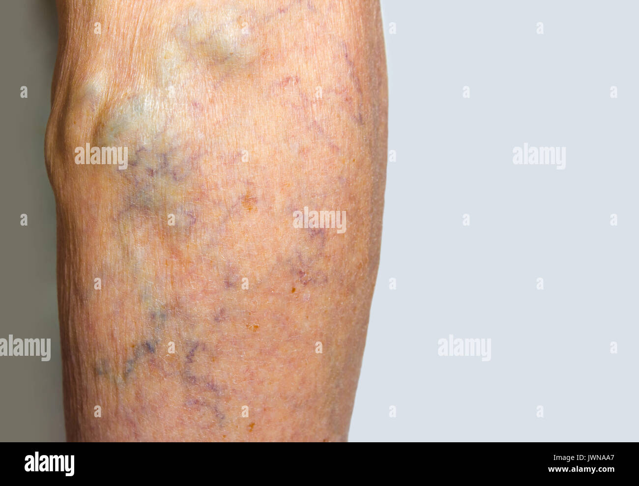 Varicose veins on a leg Stock Photo - Alamy