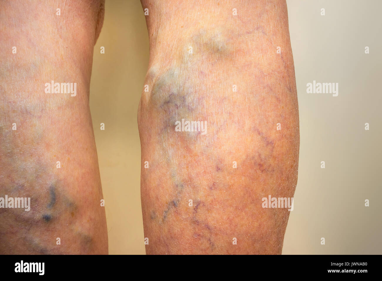 Varicose veins on a leg Stock Photo - Alamy