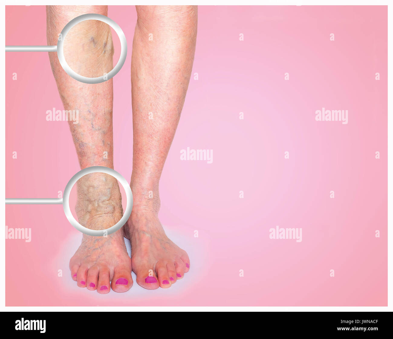Varicose veins on a female legs Stock Photo - Alamy