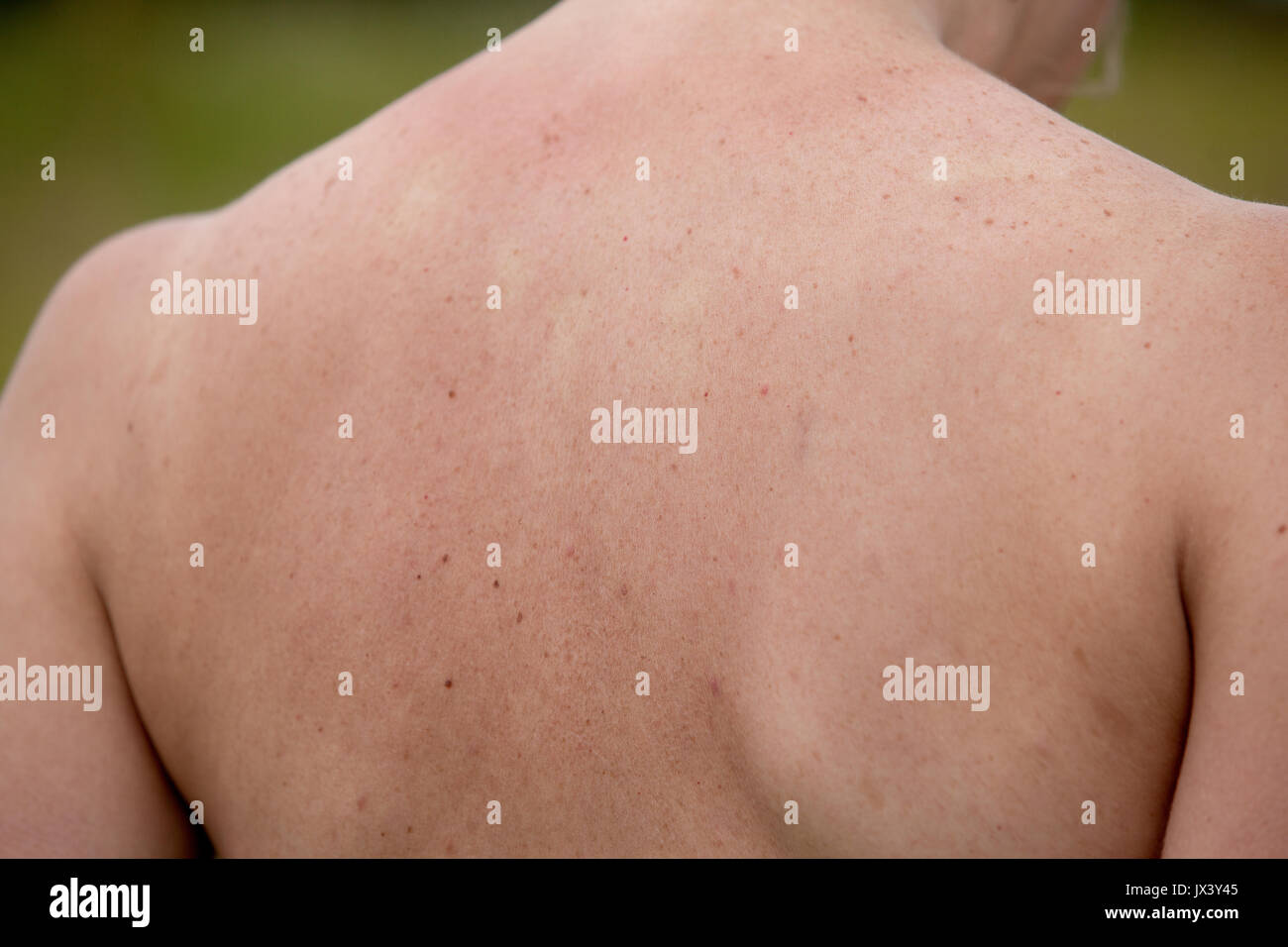 Women with skin pigmentation on back. Skin texture background Stock ...