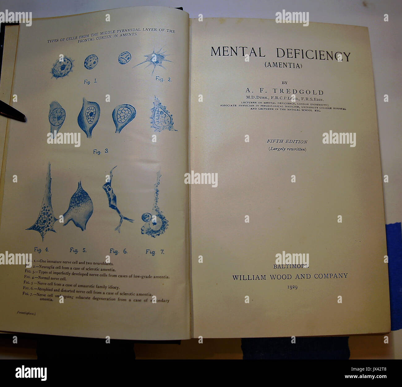'MENTAL DEFICIENCY' (Amentia), FIFTH EDITION, 1929 IMG 3569 edited 1 ...