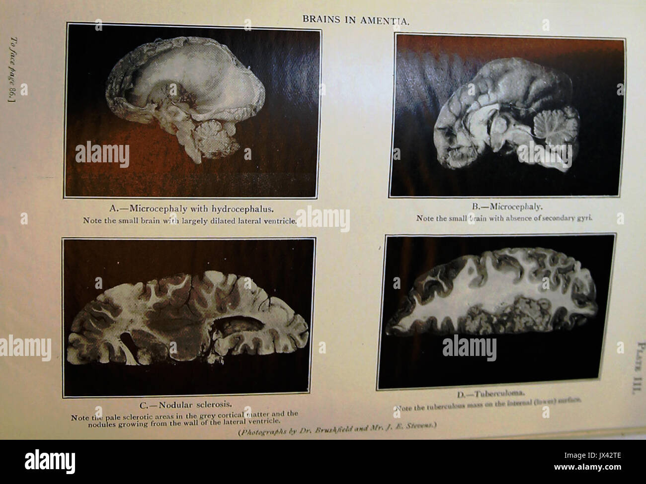 'MENTAL DEFICIENCY' (Amentia), FIFTH EDITION, 1929 IMG 3569 edited 5 ...