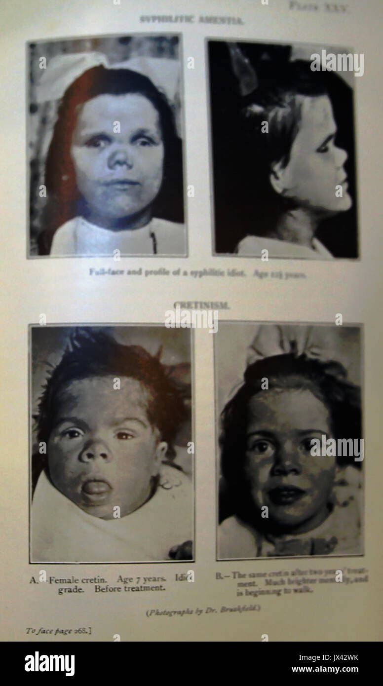 'MENTAL DEFICIENCY' (Amentia), FIFTH EDITION, 1929 IMG 3569 edited 23 ...
