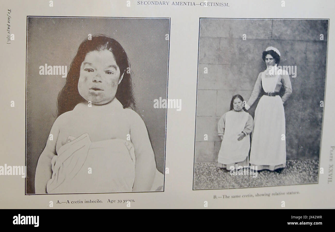 'MENTAL DEFICIENCY' (Amentia), FIFTH EDITION, 1929 IMG 3569 edited 26 ...