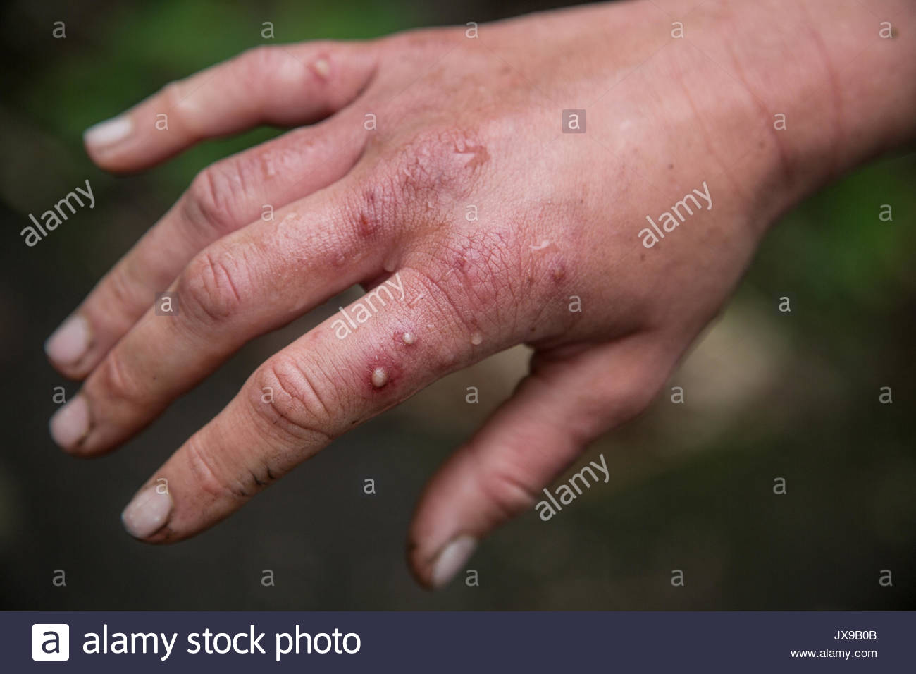 Chilblains Stock Photos & Chilblains Stock Images - Alamy