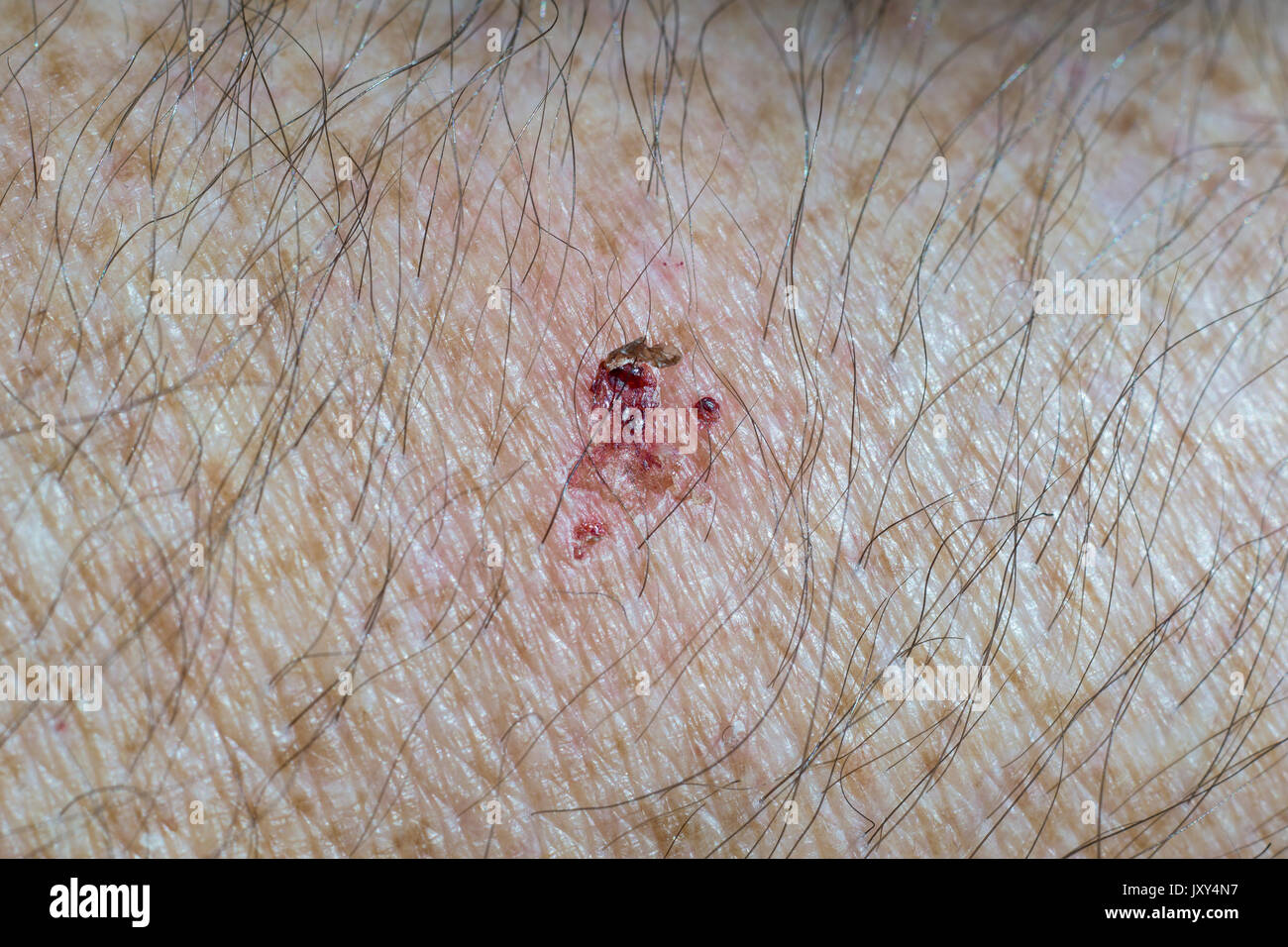 Skin injury hi-res stock photography and images - Alamy