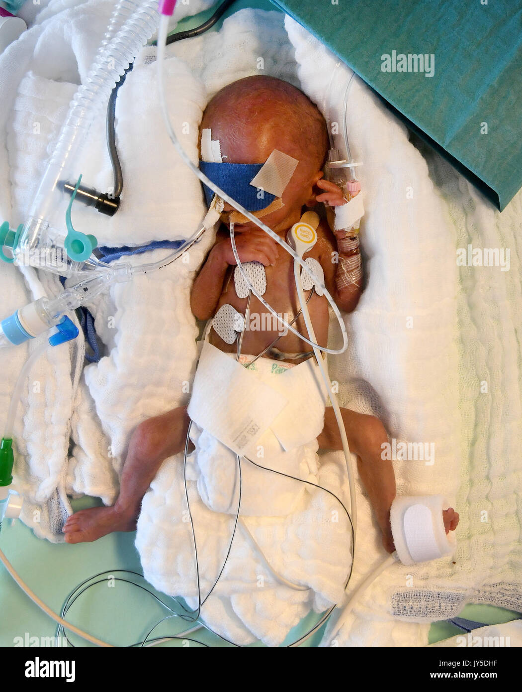 Hanover, Germany. 11th Aug, 2017. A 5-day-old boy who weighed 430 grams ...