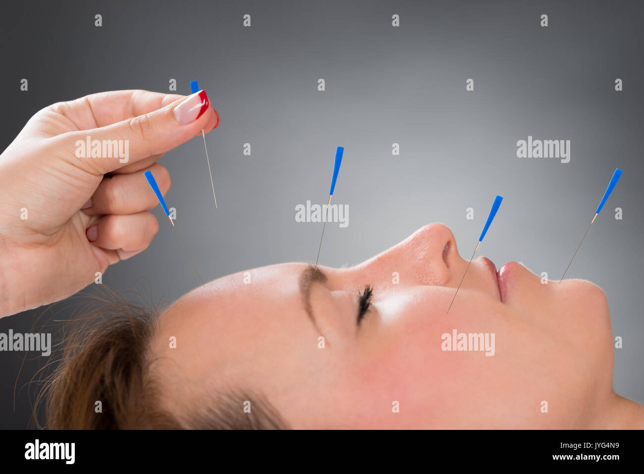 Close-up Person Hands Putting Acupuncture Needle On Face Of Young Woman ...