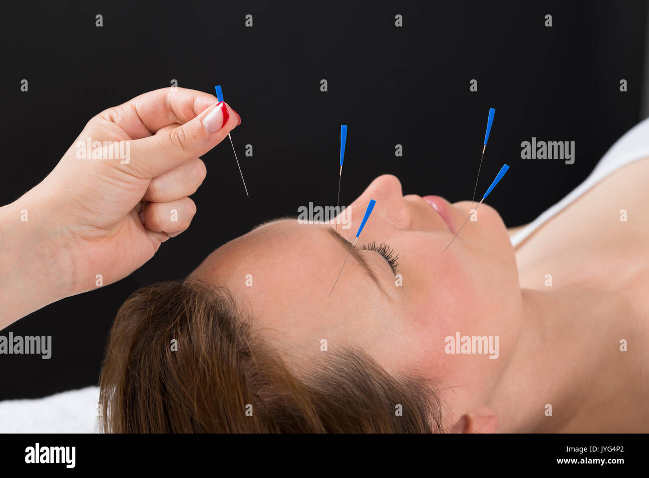 Close-up Person Hands Putting Acupuncture Needle On Face Of Young Woman ...