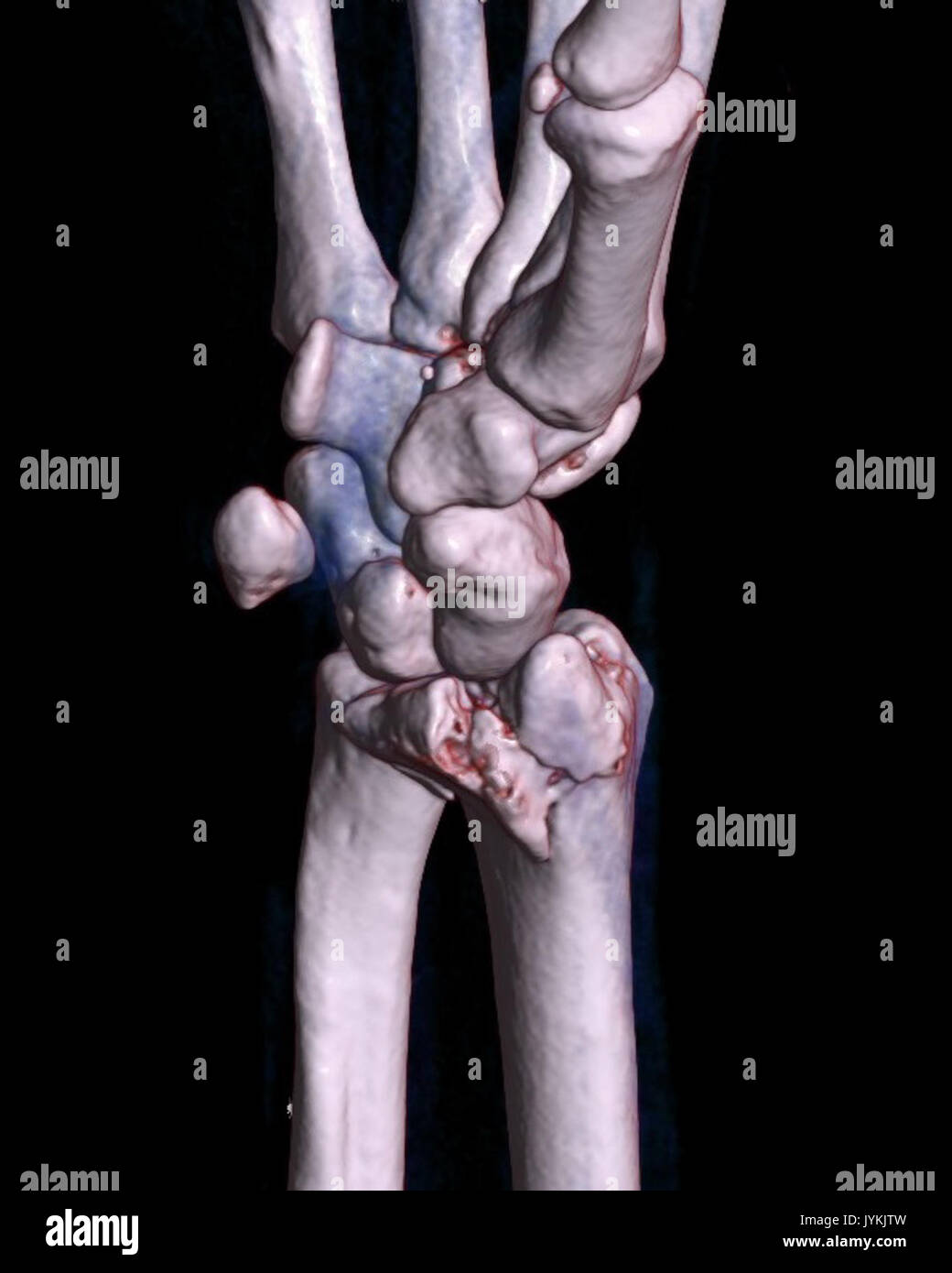 3D rendered CT of Barton's fracture Stock Photo - Alamy