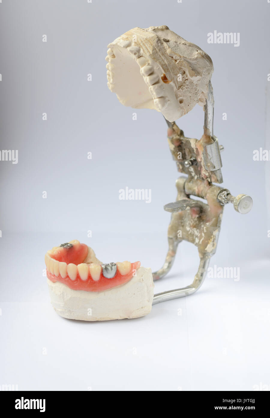 Artificial tooth, dental prosthesis with false silver tooth, metalic ...