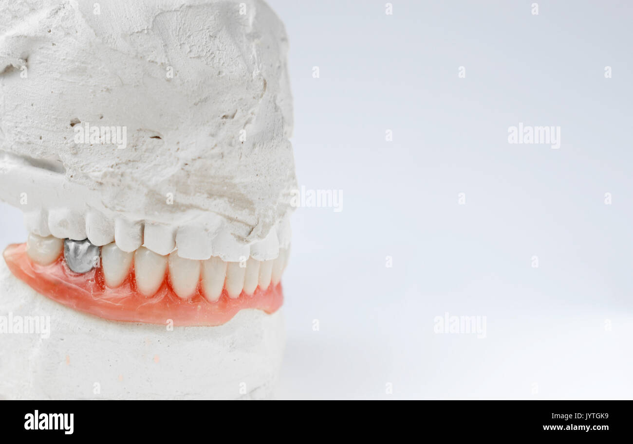 Artificial tooth, dental prosthesis with false silver tooth, metalic ...