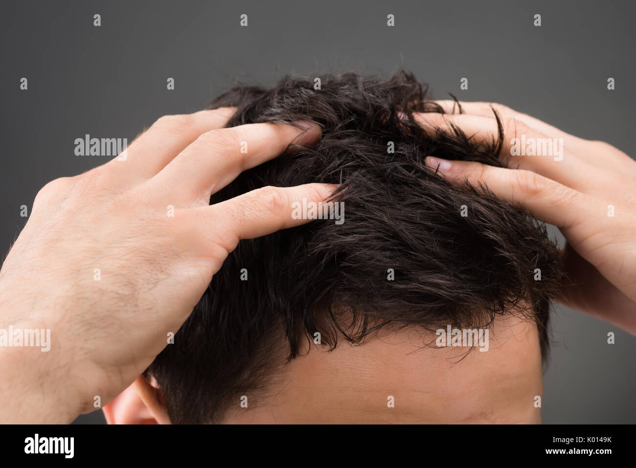 Man suffering from hair loss hi-res stock photography and images - Alamy