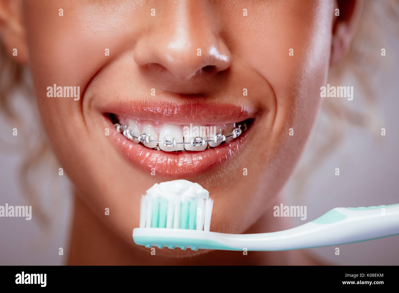 Close-up of a smiling woman face with braces on white teeth and ...
