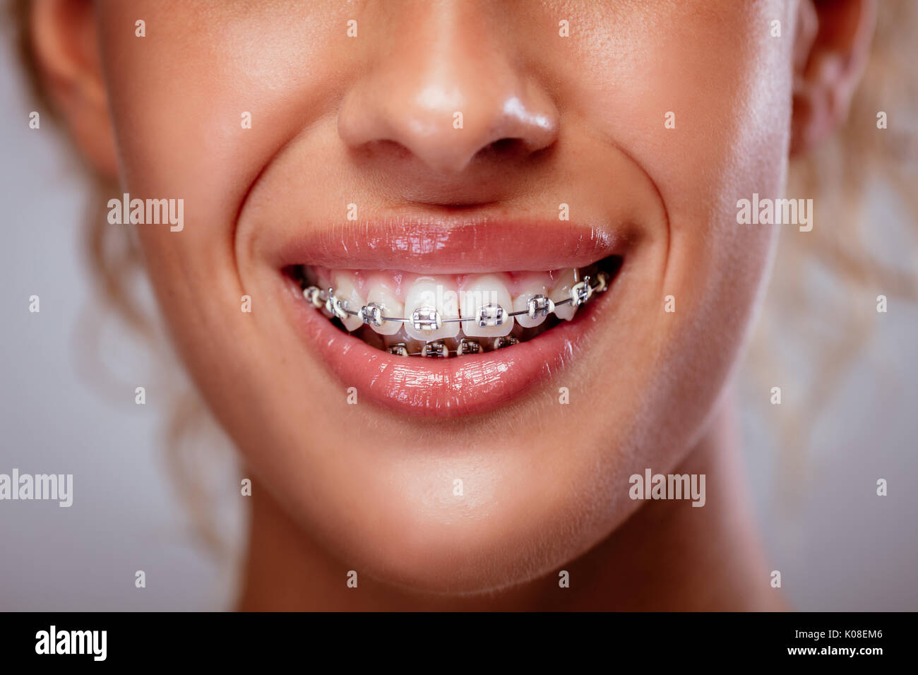 Brace teeth hi-res stock photography and images - Alamy