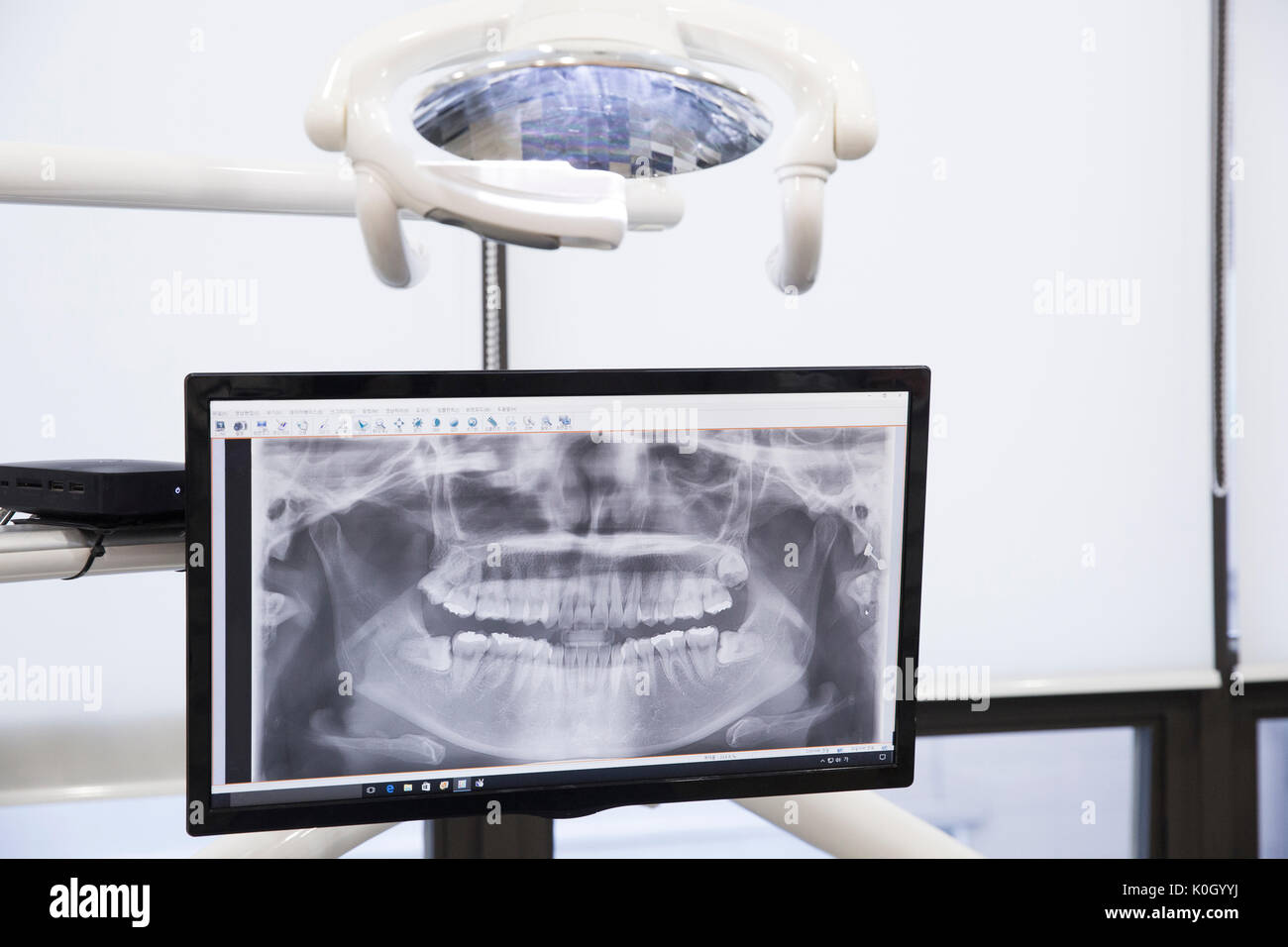 X-ray picture of teeth on computer monitor at dental clinic Stock Photo ...