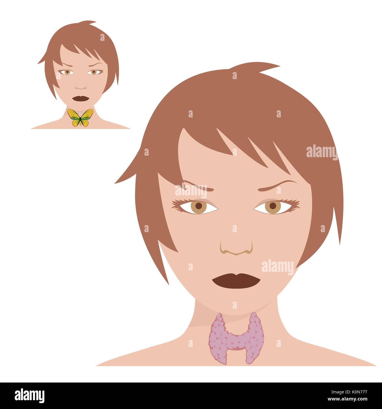 vector illustration of thyroid with hashimotos disease Stock Vector ...