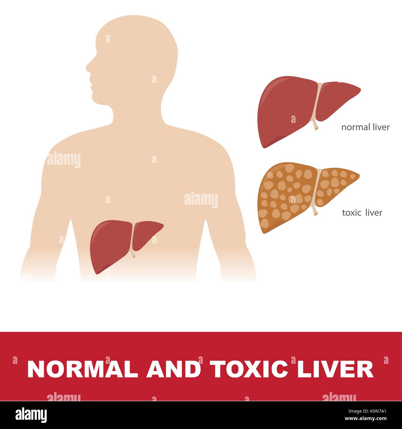 vector illustration of comparison of healthy and toxic liver Stock ...