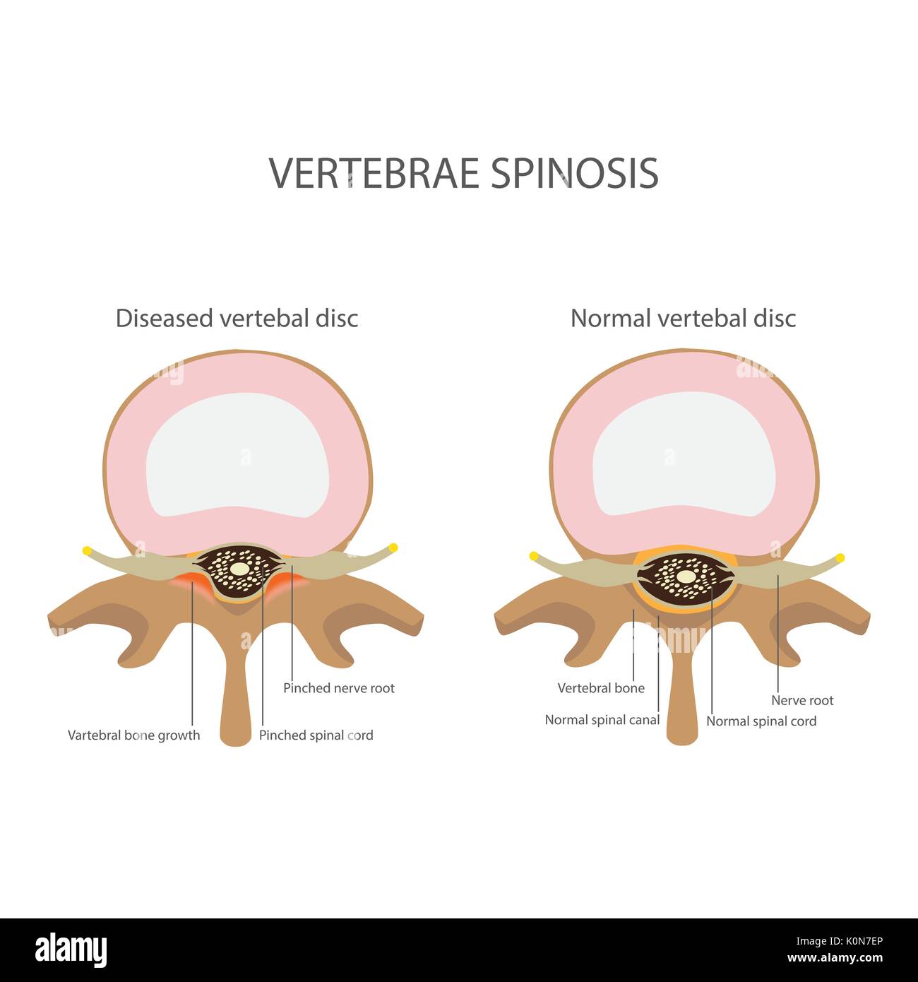 Vertebrae discs hi-res stock photography and images - Alamy
