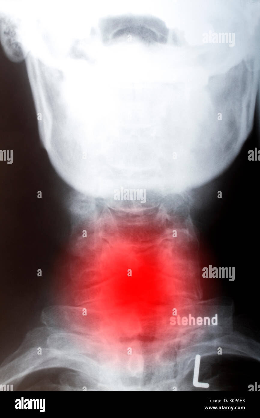 Human neck in front in x-ray Stock Photo - Alamy
