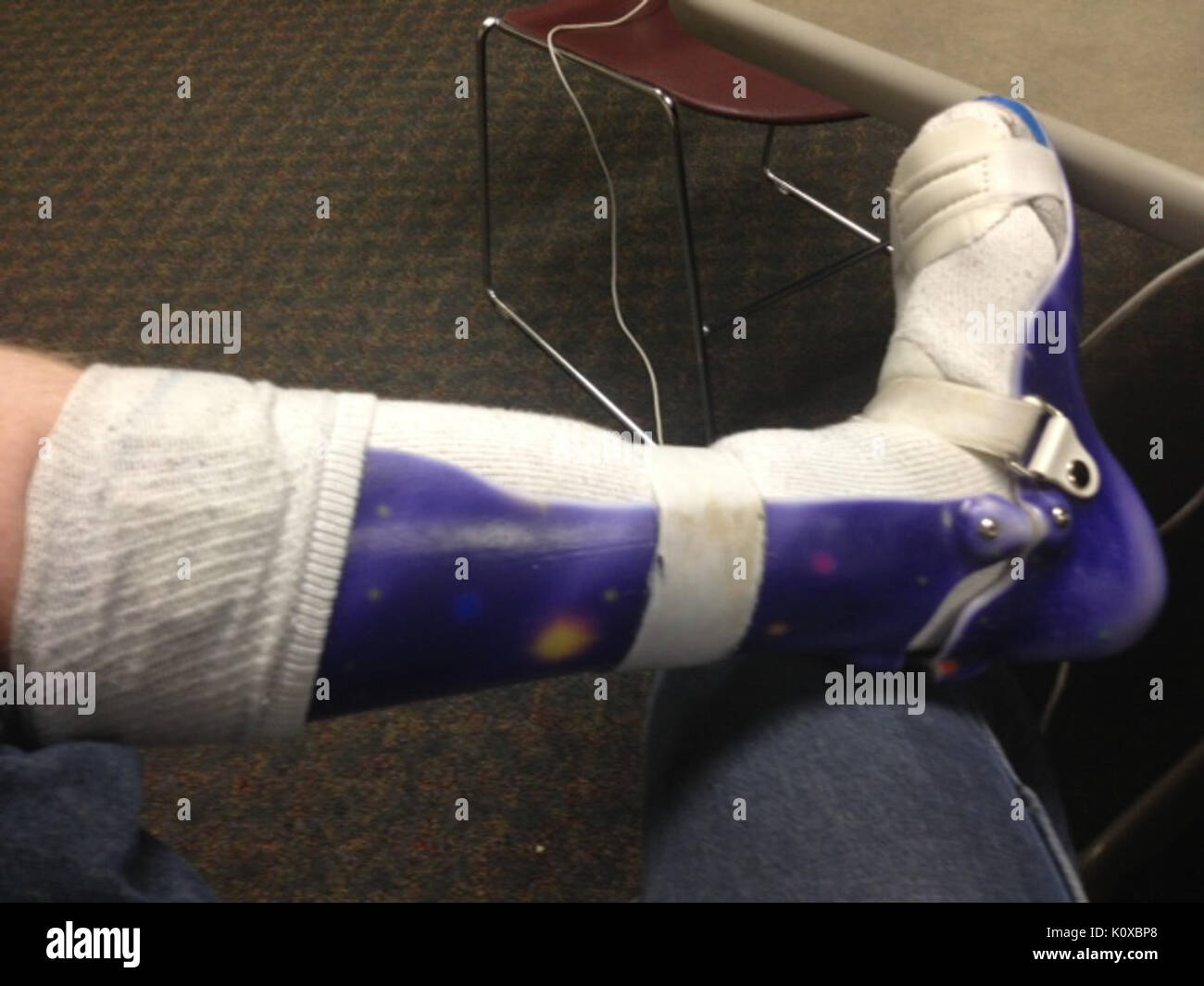 Ankle Foot Orthosis leg brace worn on the left foot with ankle hinge ...