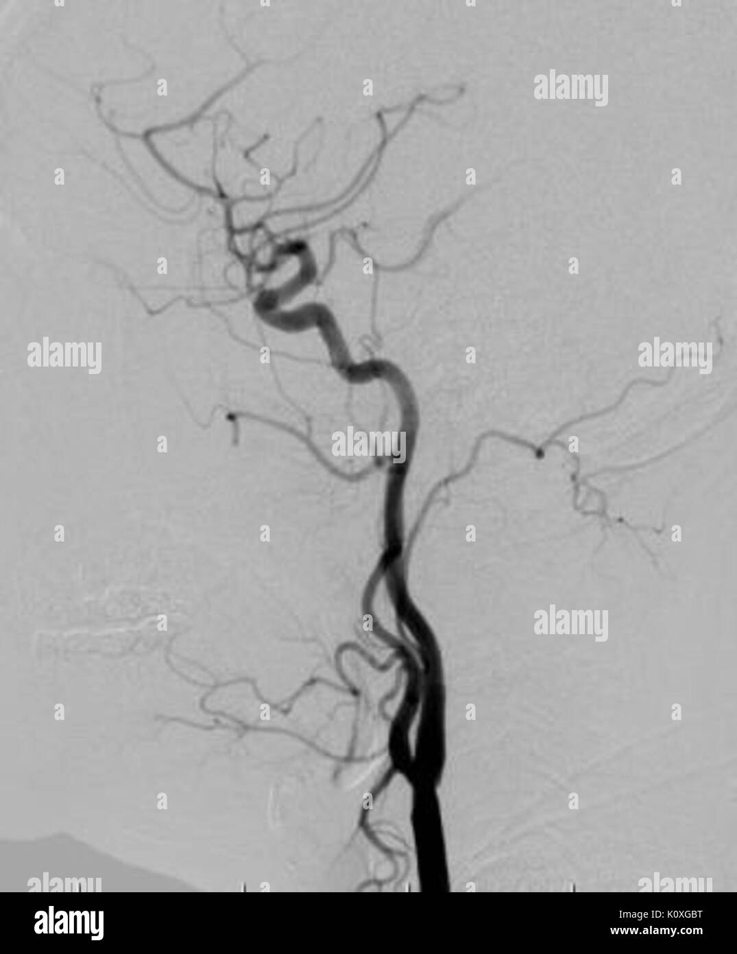 Angiogram Black and White Stock Photos & Images - Alamy