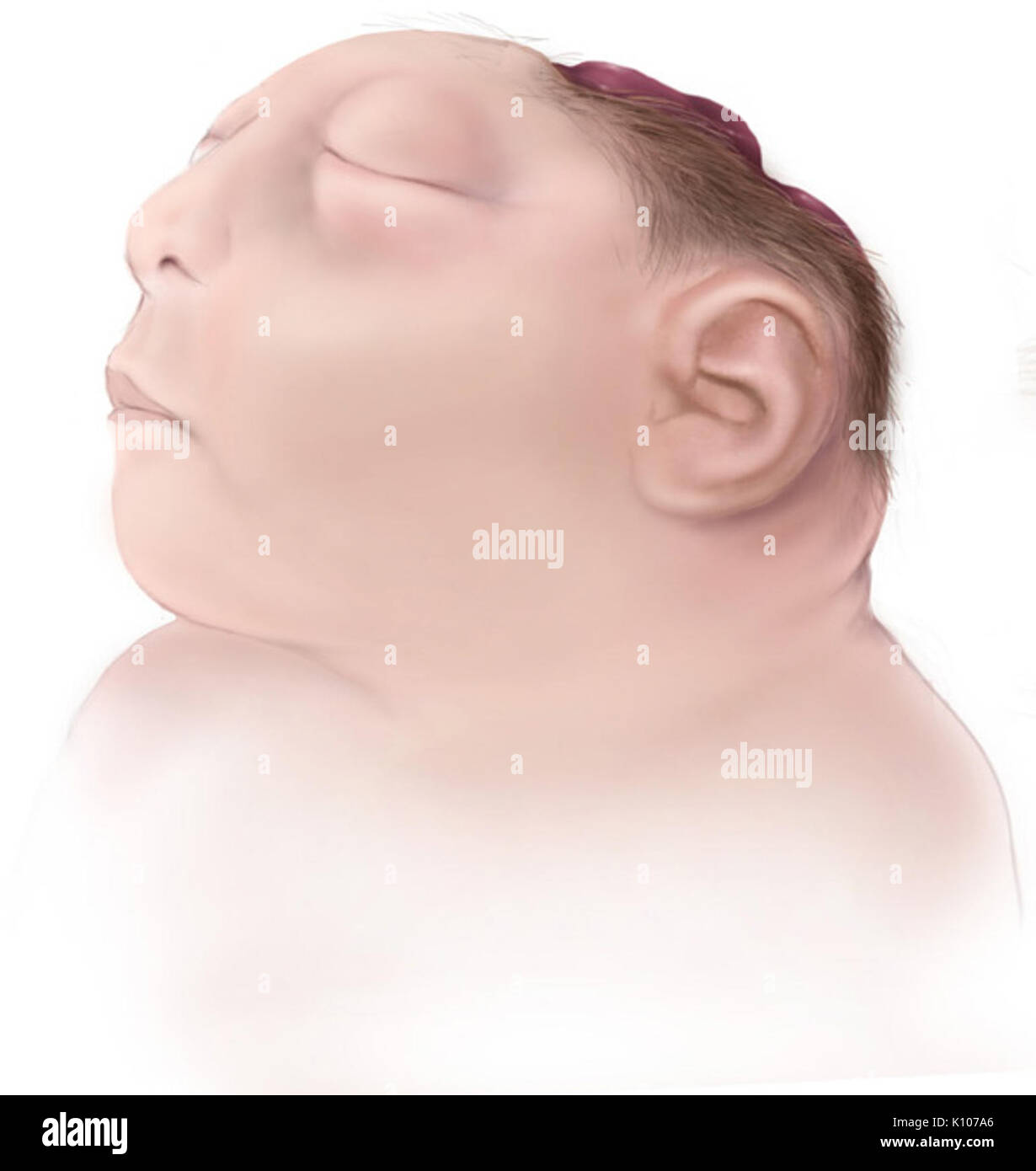 Anencephaly hi-res stock photography and images - Alamy