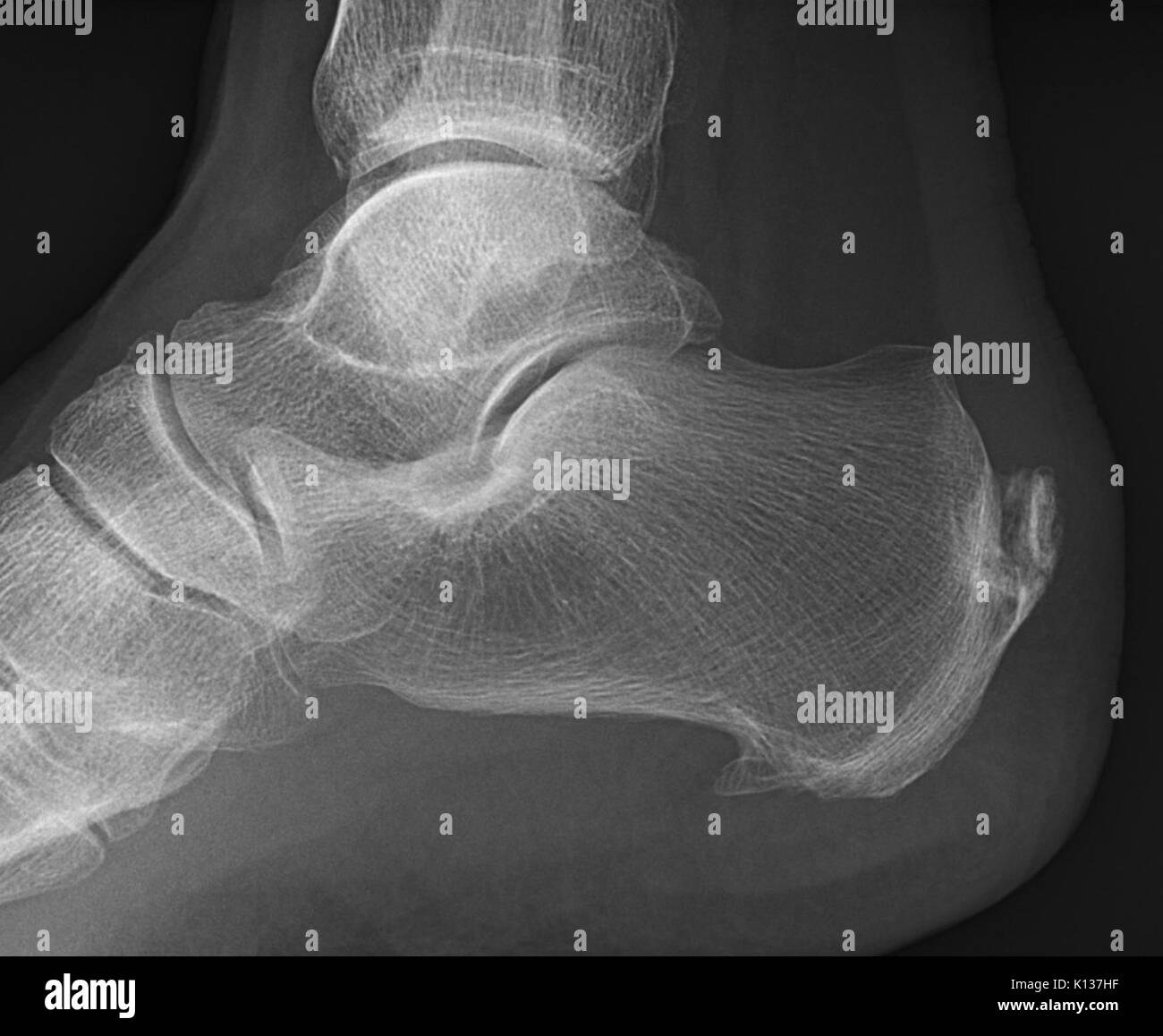 Achilles insertional calcific tendinosis Stock Photo - Alamy